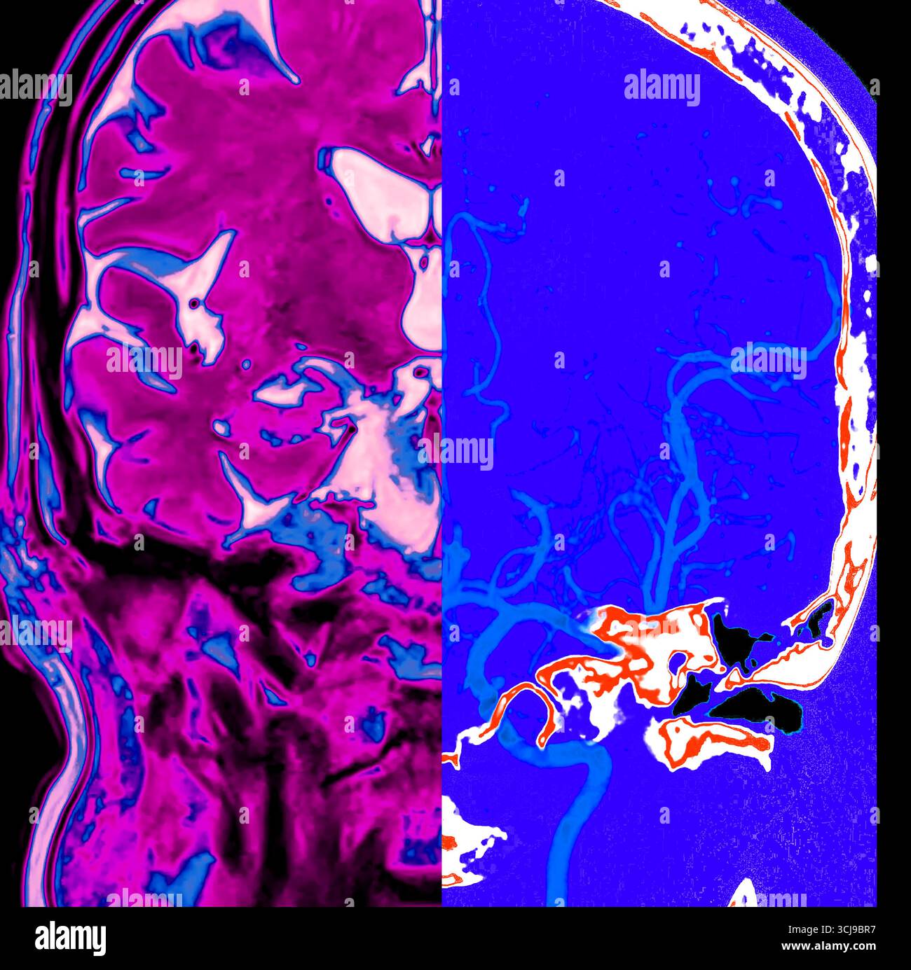 A vivid cerebral angiogram reveals the intricate network of brain ...