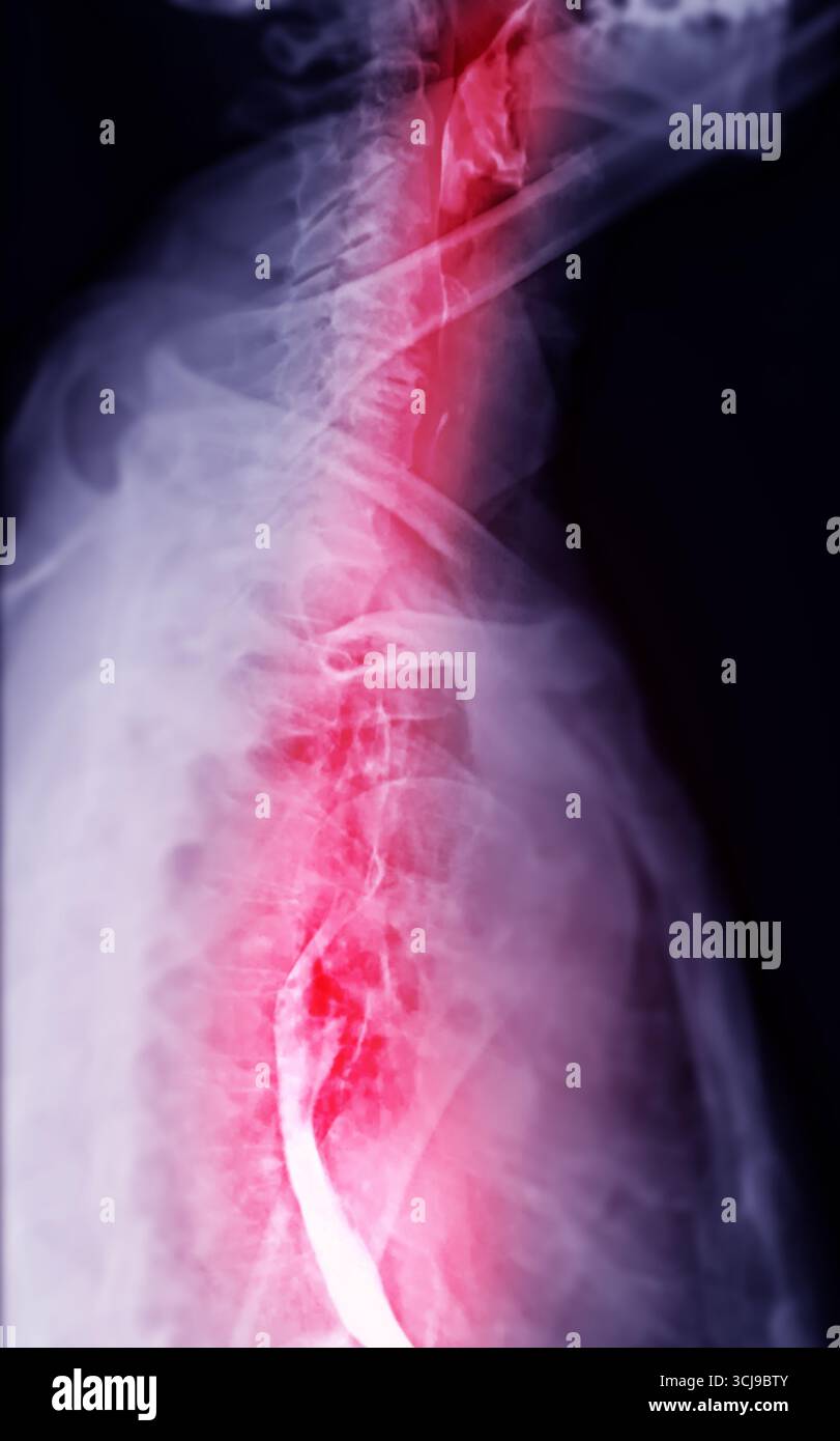 Fluoroscopic footage of a barium swallow test showing real-time ...
