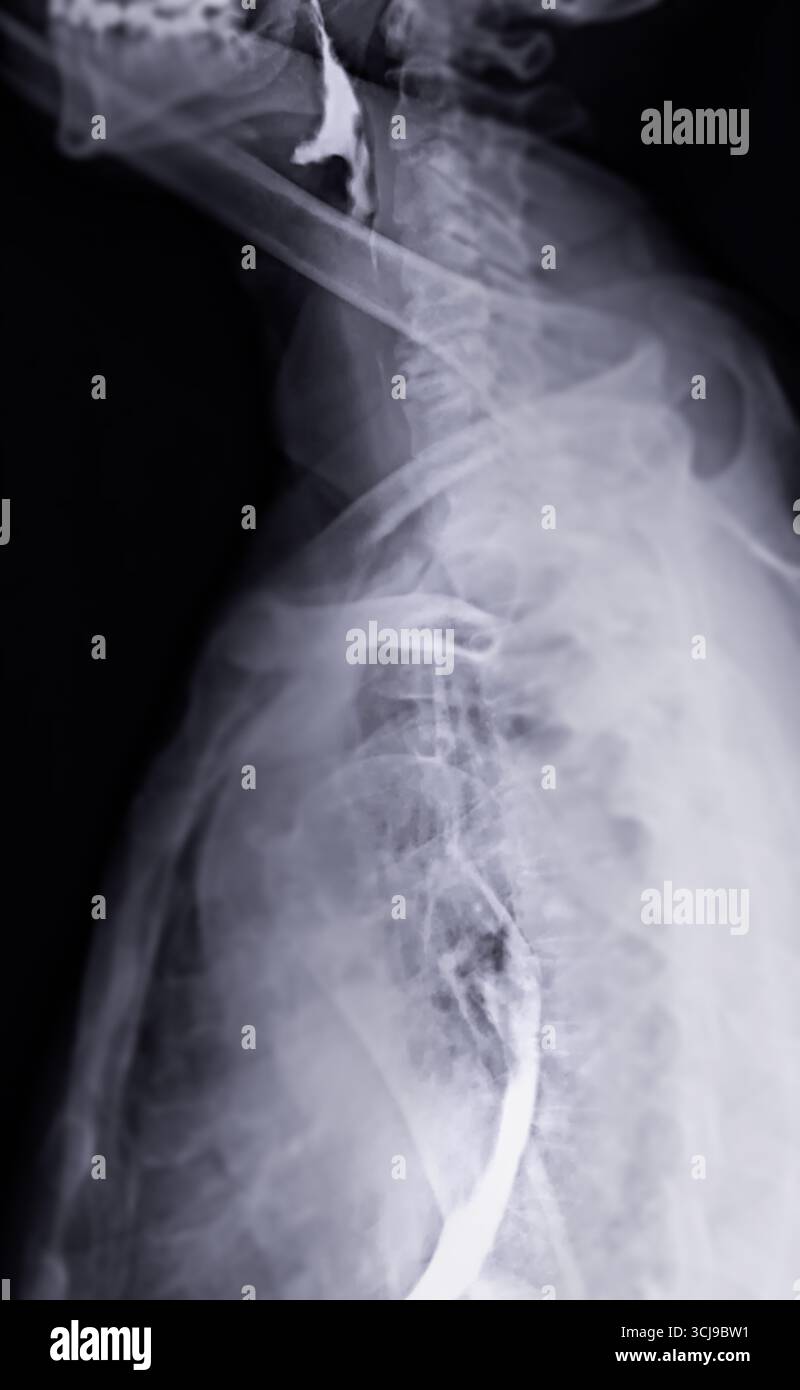 Fluoroscopic footage of a barium swallow test showing real-time ...