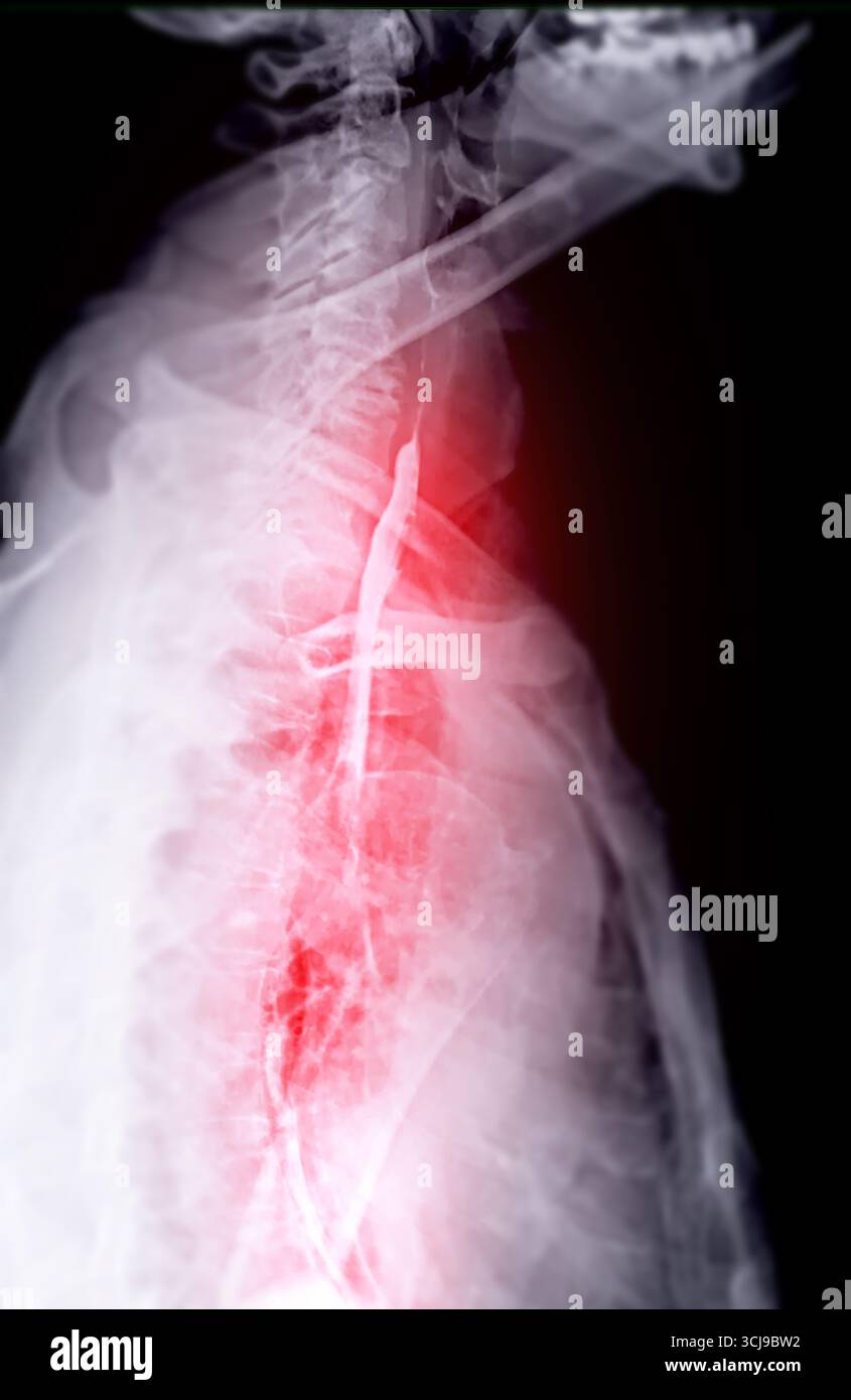 Fluoroscopic footage of a barium swallow test showing real-time ...