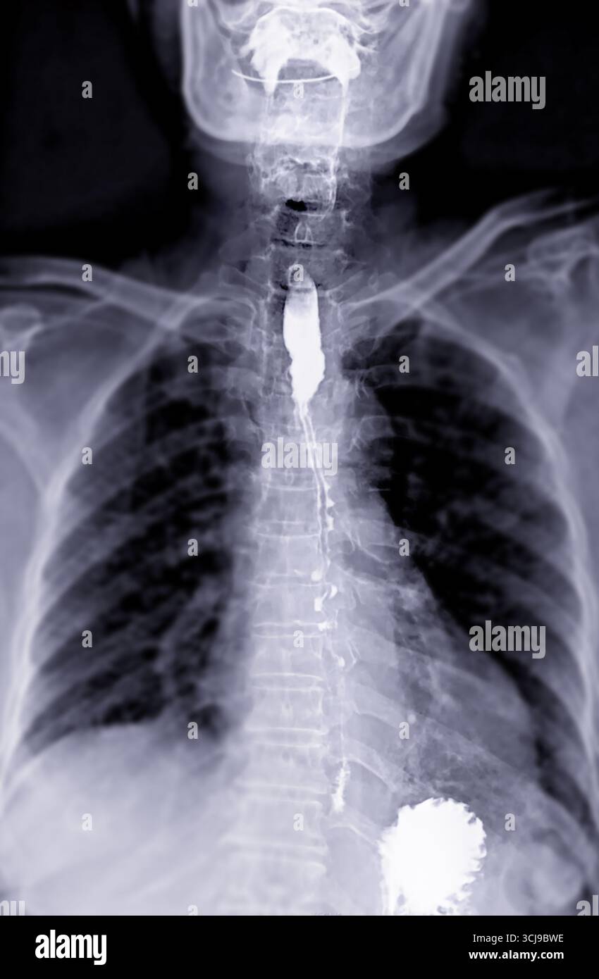 Fluoroscopic footage of a barium swallow test showing real-time ...