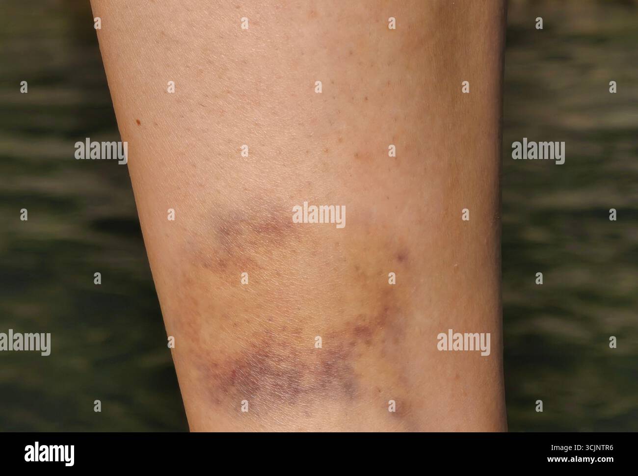 Close-Up of Bruised Human Skin – Medical Treatment Focus Stock Photo ...