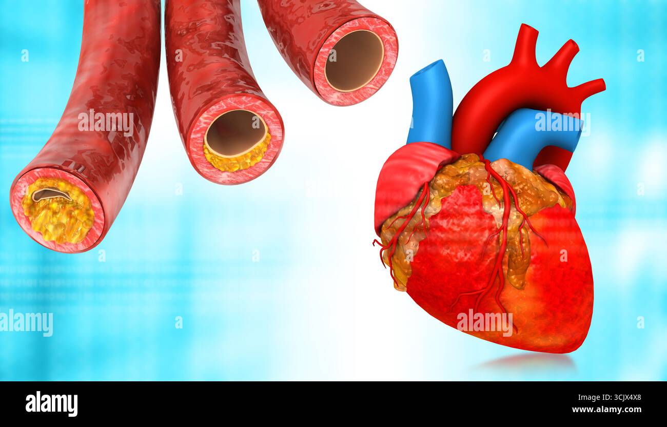 Human heart with clogged arteries. 3d illustration Stock Photo - Alamy