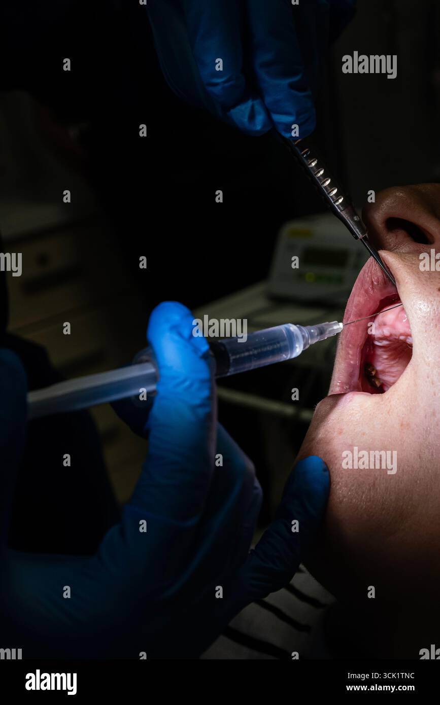 During implant treatment, a doctor performs an injection. The dentist ...
