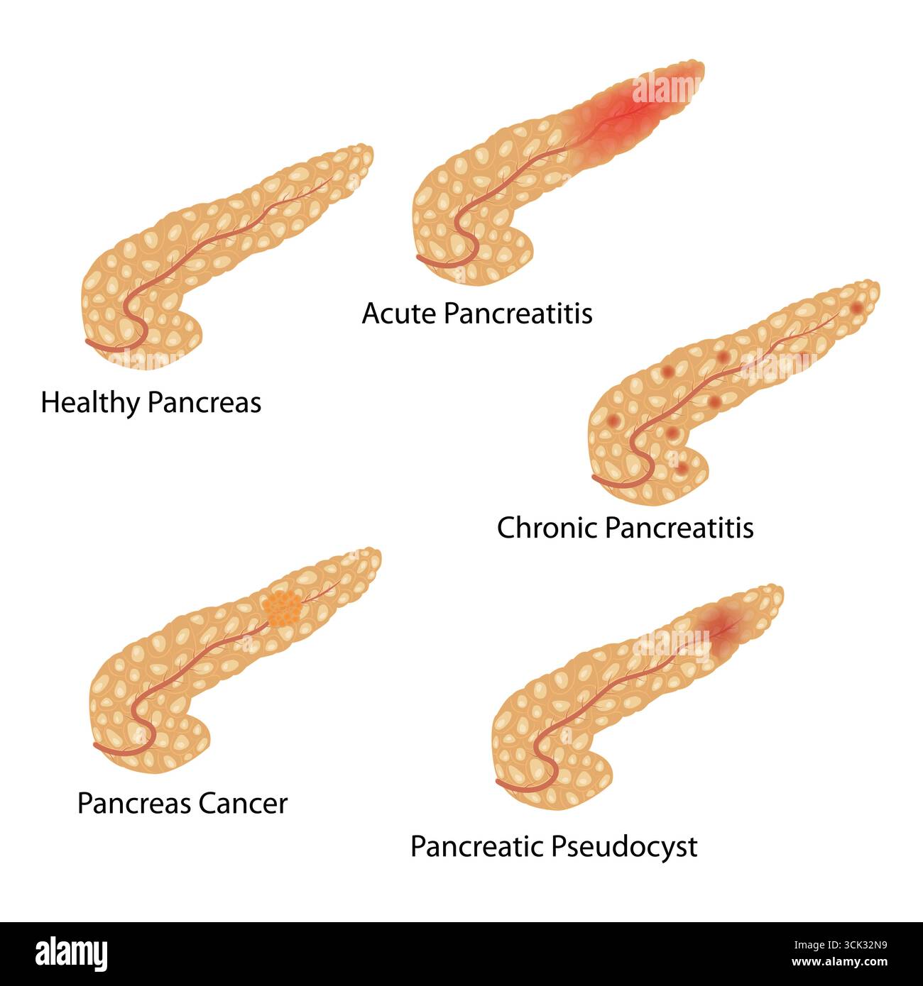 Medical Comparison Diagram of Pancreas Conditions: Healthy Pancreas ...