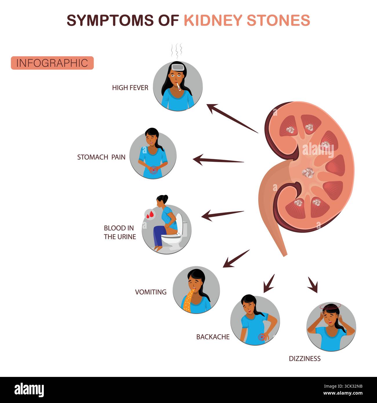 Kidney Stone Symptoms Infographic with Illustrations of Fever, Stomach ...