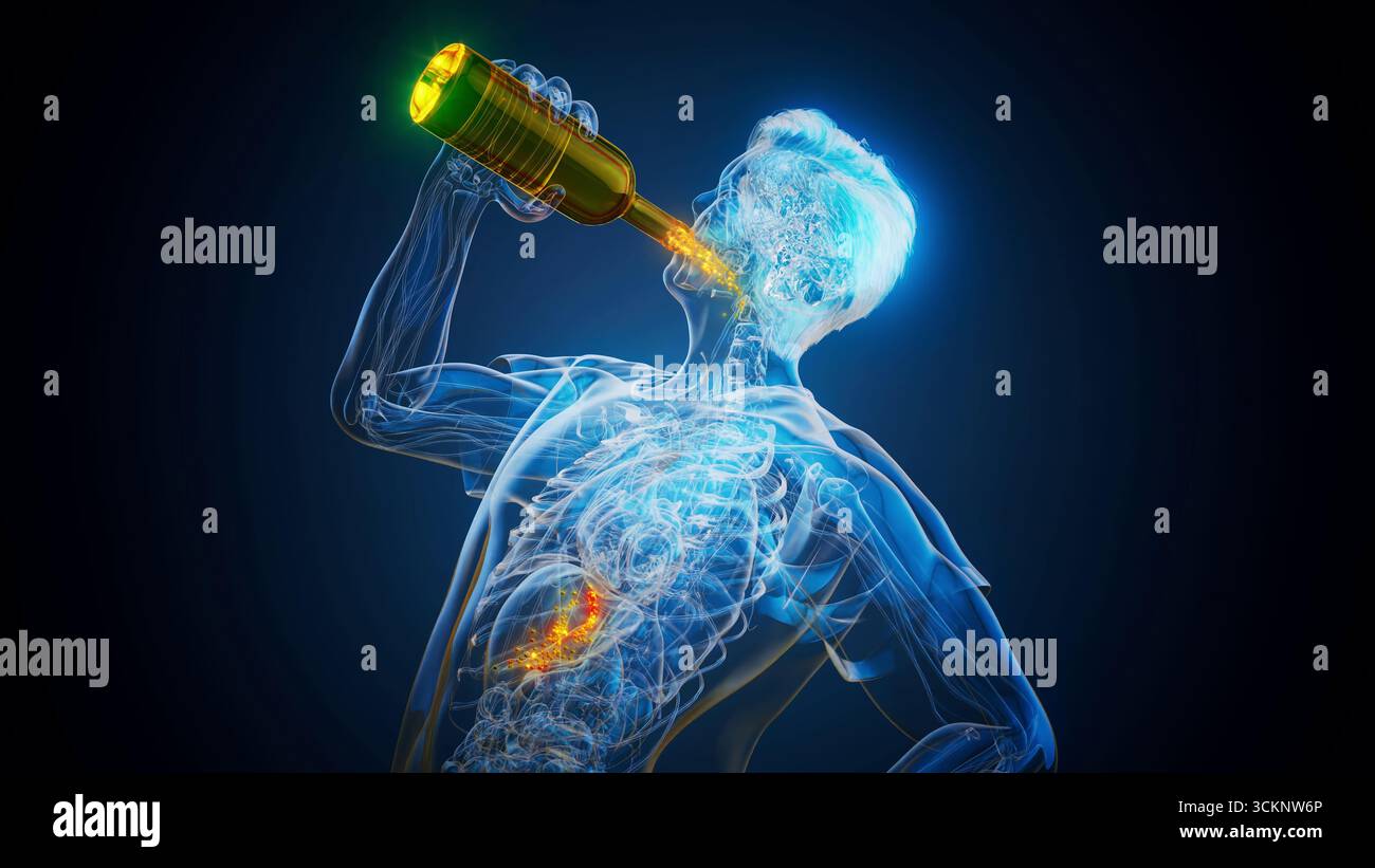 Alcoholic liver damage, conceptual illustration Stock Photo - Alamy