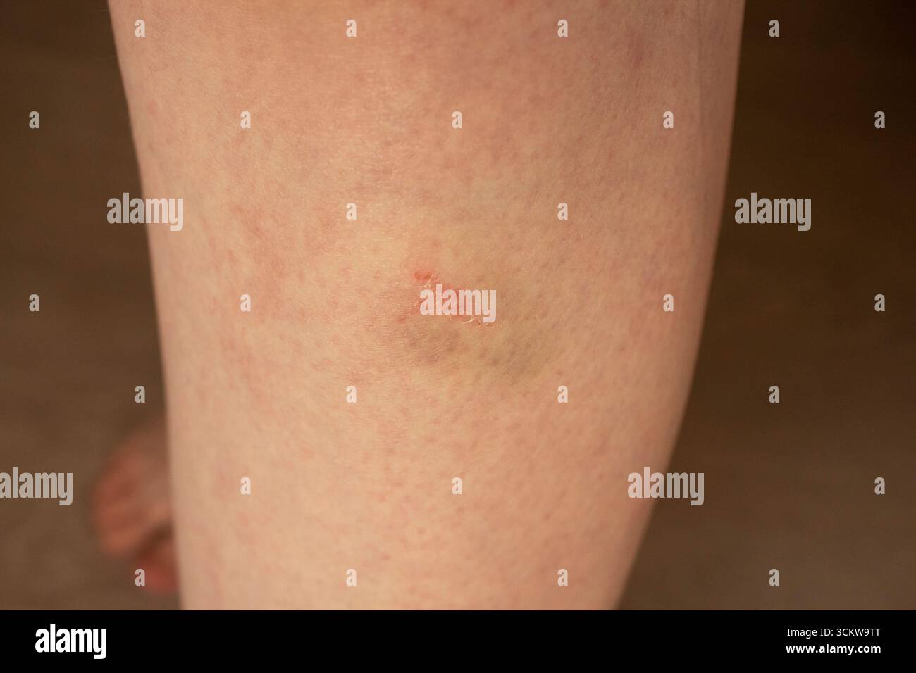 Healing wound on womans hi-res stock photography and images - Alamy