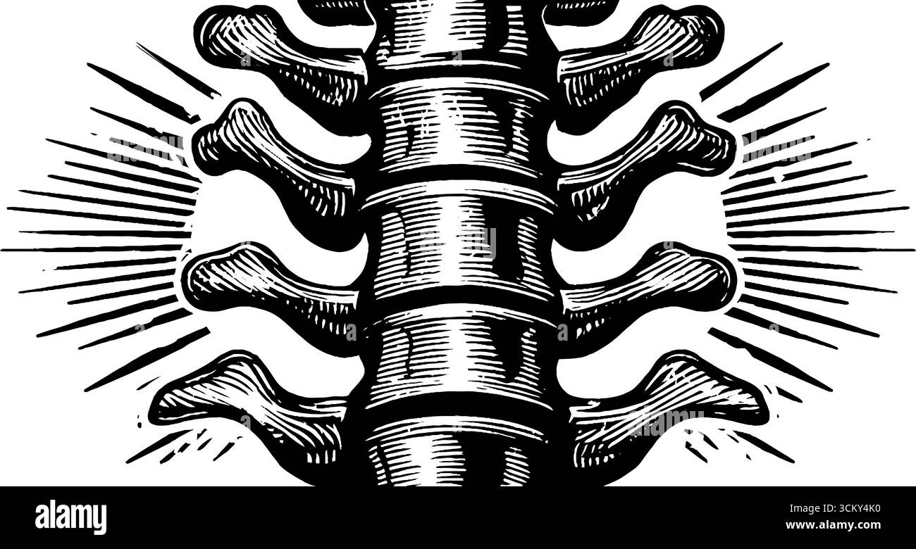 Anatomical illustration of spinal disc compression between vertebrae ...