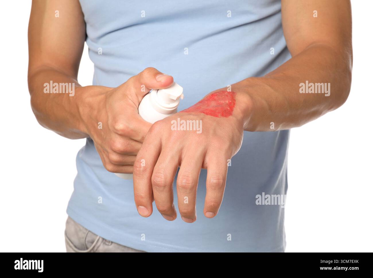 Man applying healing cream onto burned hand on white background ...