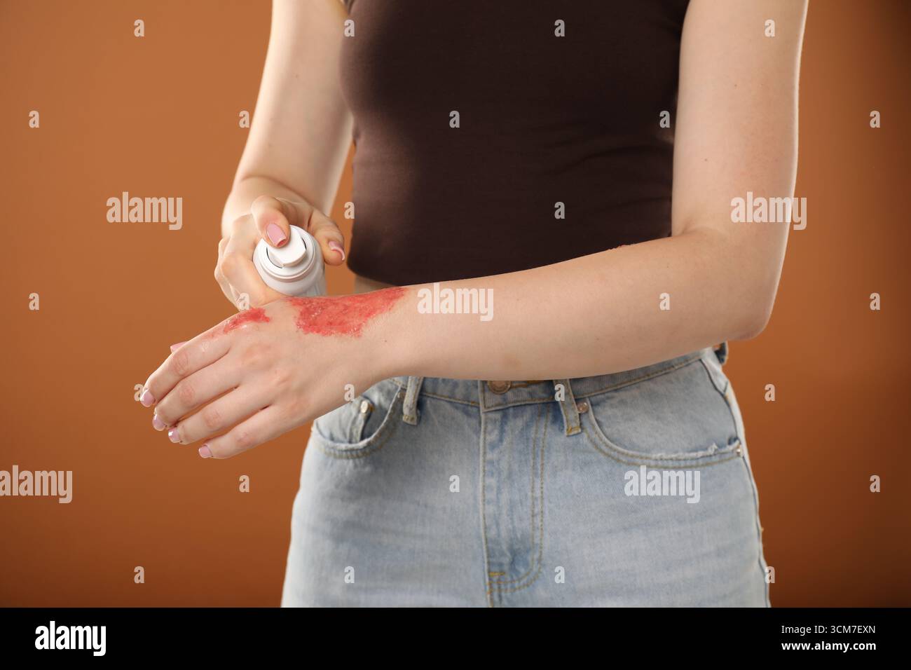 Woman applying healing cream onto burned hand on brown background ...