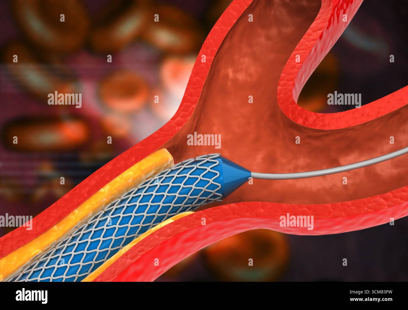 Blocked coronary arteries hi-res stock photography and images - Alamy