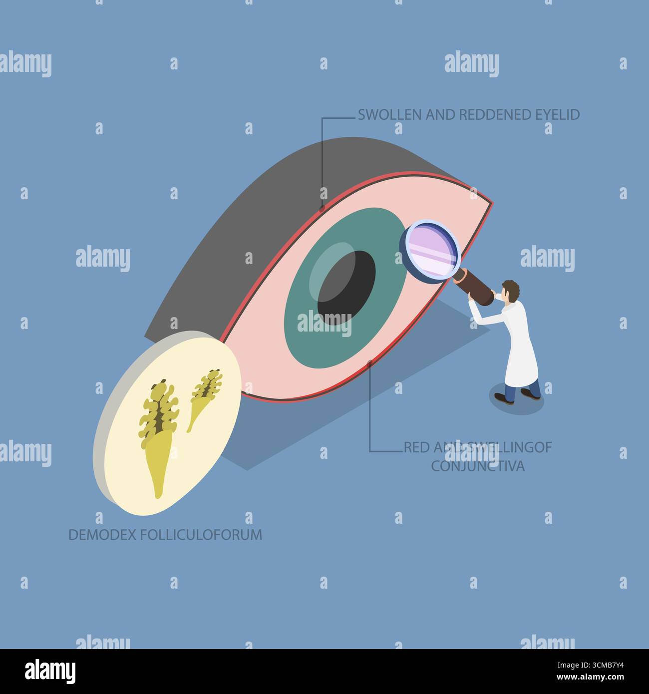 3D Isometric Flat Illustration of Demodex Folliculorum, Demodicosis ...