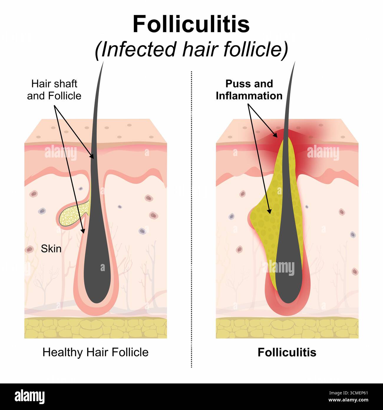 Folliculitis (infected hair follicle) skin flashcard illustration Stock ...