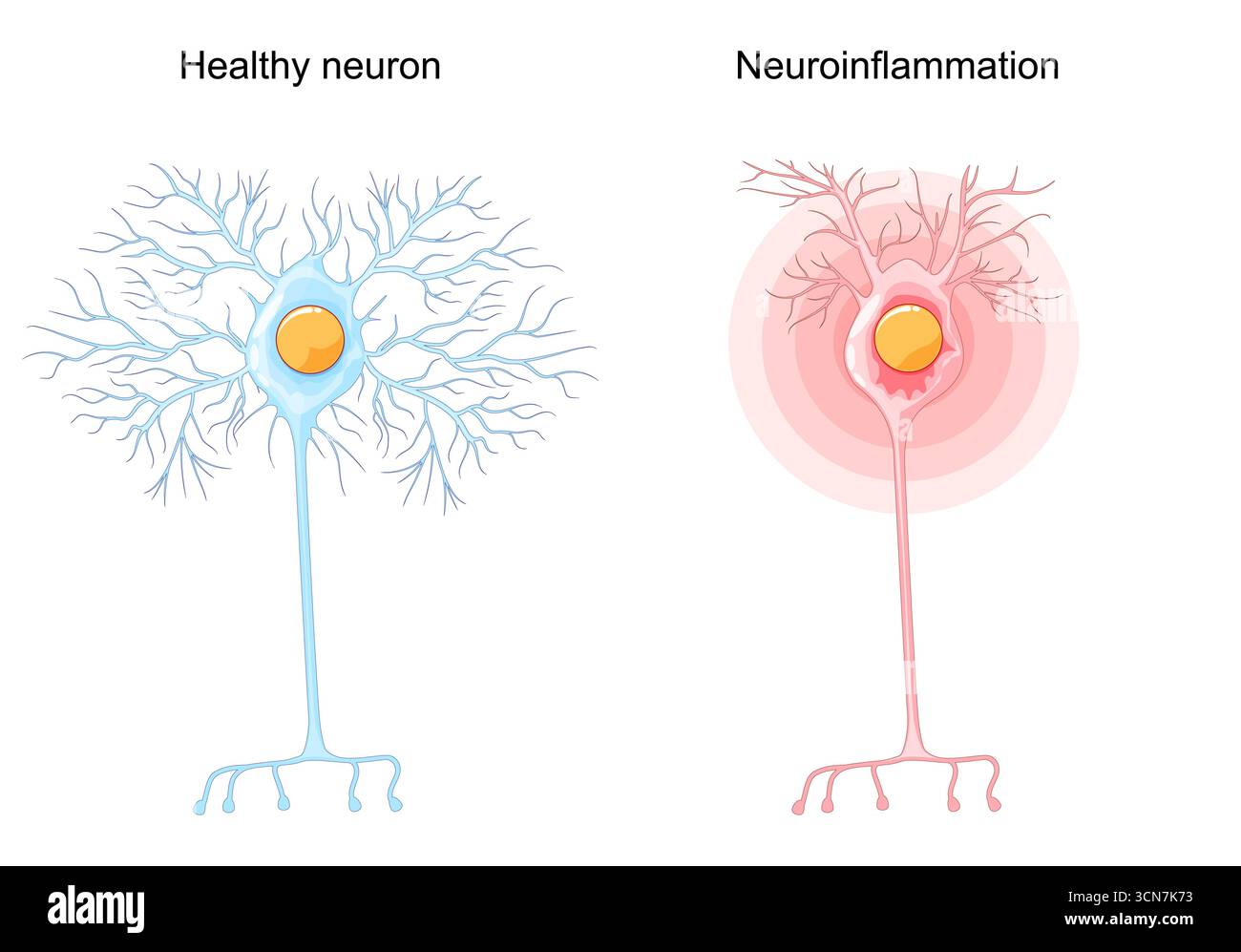 Neuroinflammation. Healthy neuron and unhealthy nerve cell ...