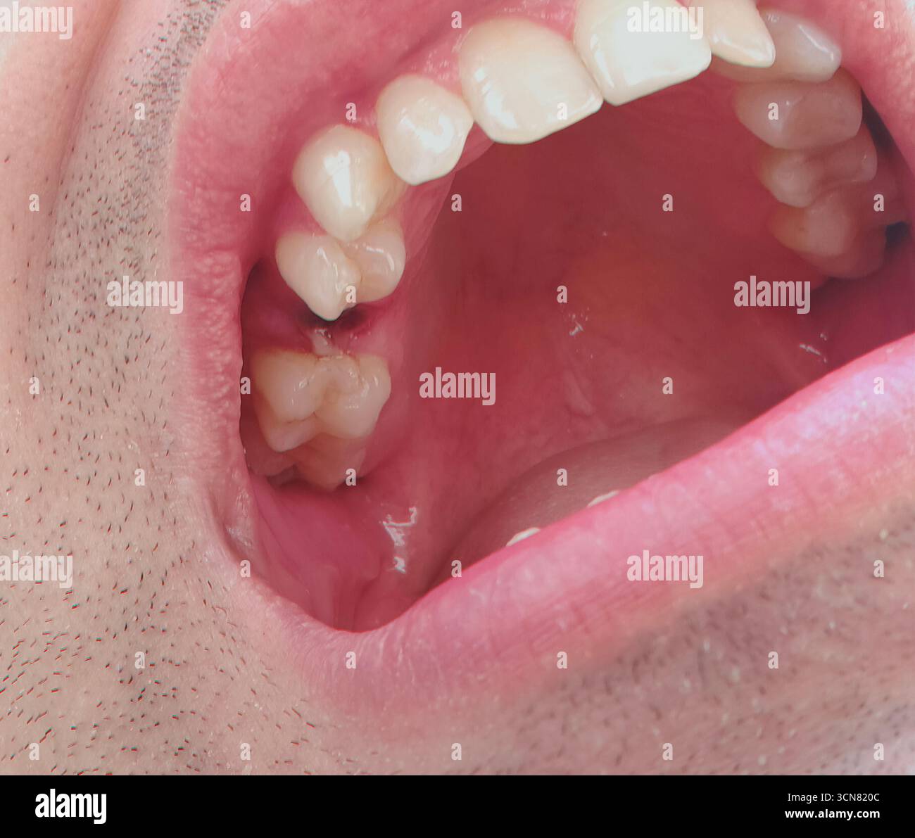 open mouth of a man with the place of a pulled out small molar tooth ...