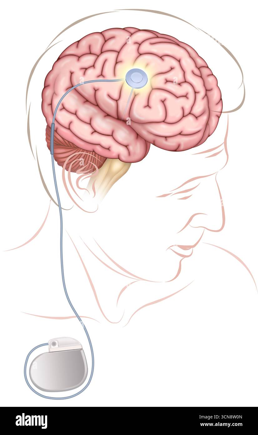 Illustration focusing on brain stimulation for diseases such as ...