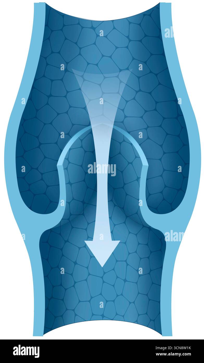 Illustration showing a vein with a varicose vein valve, where valve ...