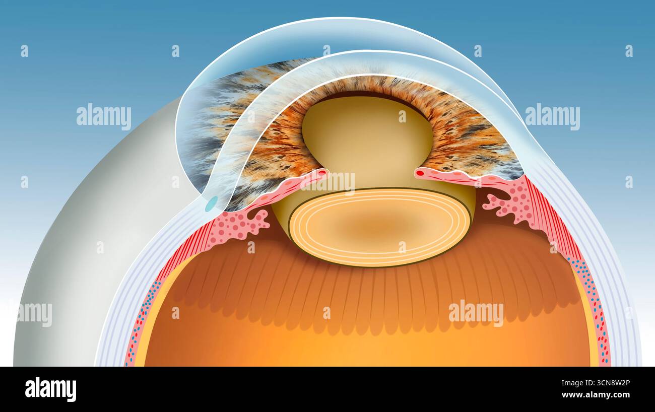 Illustration of lens opacity. This is a transparent lens within the eye ...