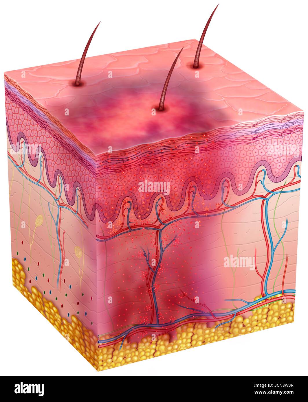 Illustration of a haematoma. Also known as a bruise, it is a spot on ...