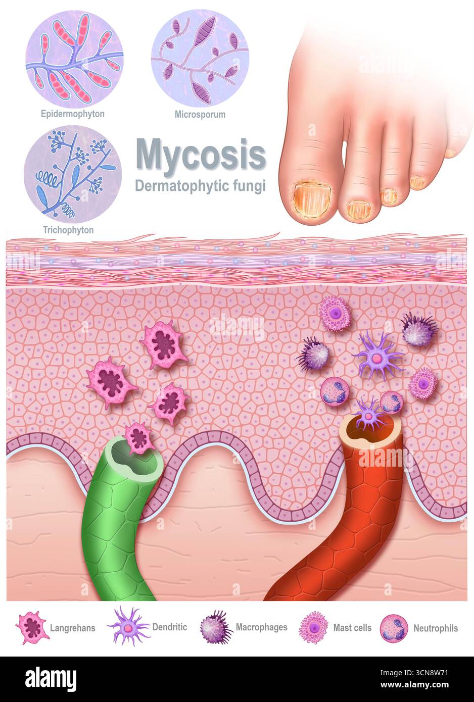 Illustration of cutaneous mycoses. These infections can be caused by ...