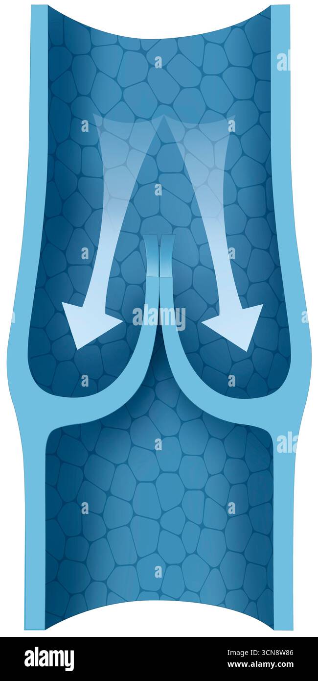 Illustration of a healthy venous valve. They are flap-like structures ...