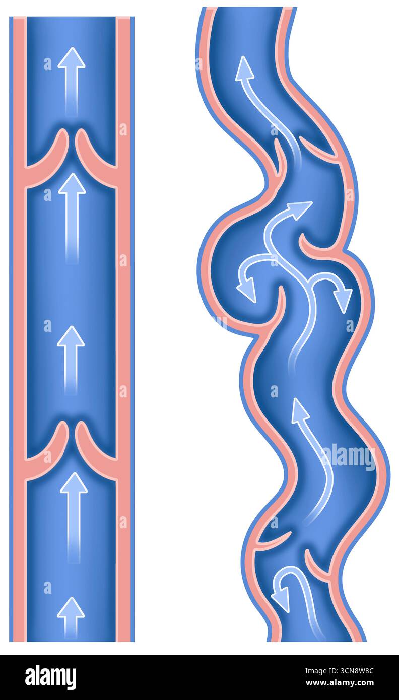 Illustration comparing a healthy vein with a varicose vein. In a ...