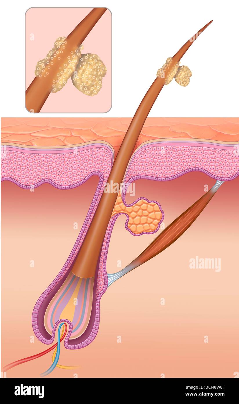 Illustration of the skin with white piedra fungal hair infection. These ...
