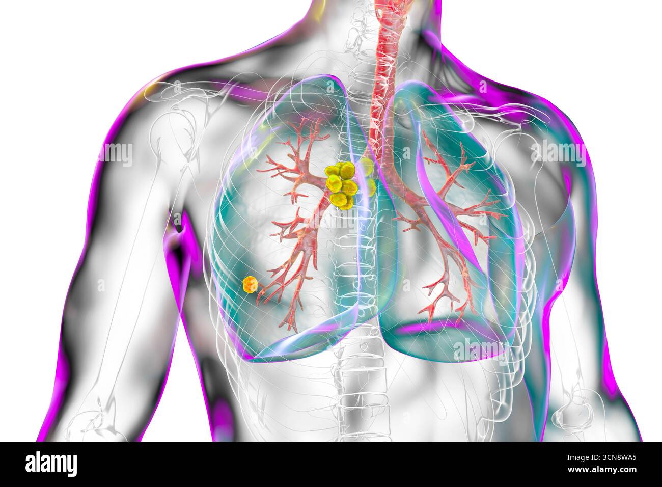 Primary lung tuberculosis. Illustration featuring the Ghon complex and ...