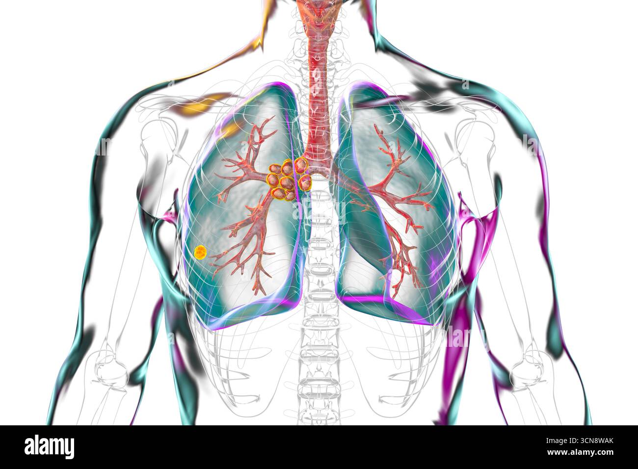 Primary lung tuberculosis with the Ranke complex. Illustration ...