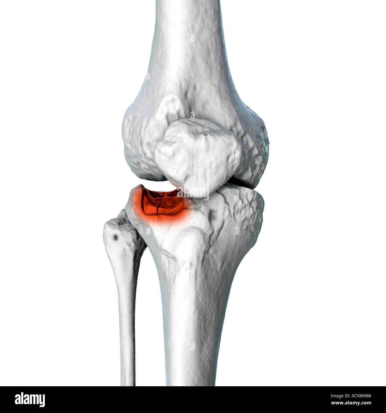 Tibia fracture schatzker type iii hi-res stock photography and images ...