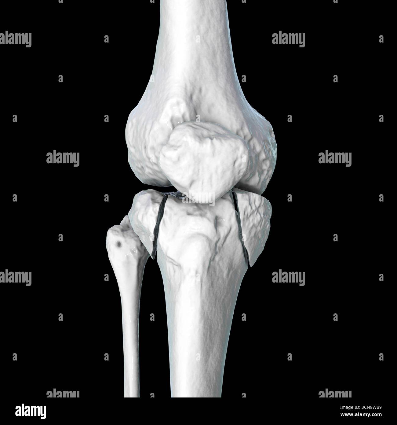 Complex fracture hi-res stock photography and images - Alamy