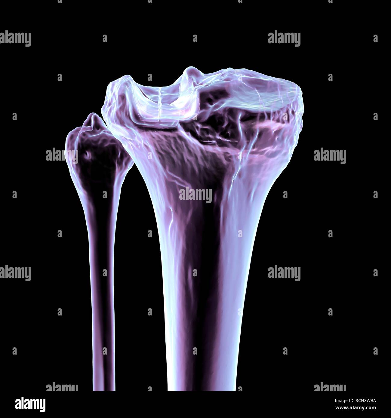 Tibia fracture Schatzker type III. Illustration showing pure depression ...