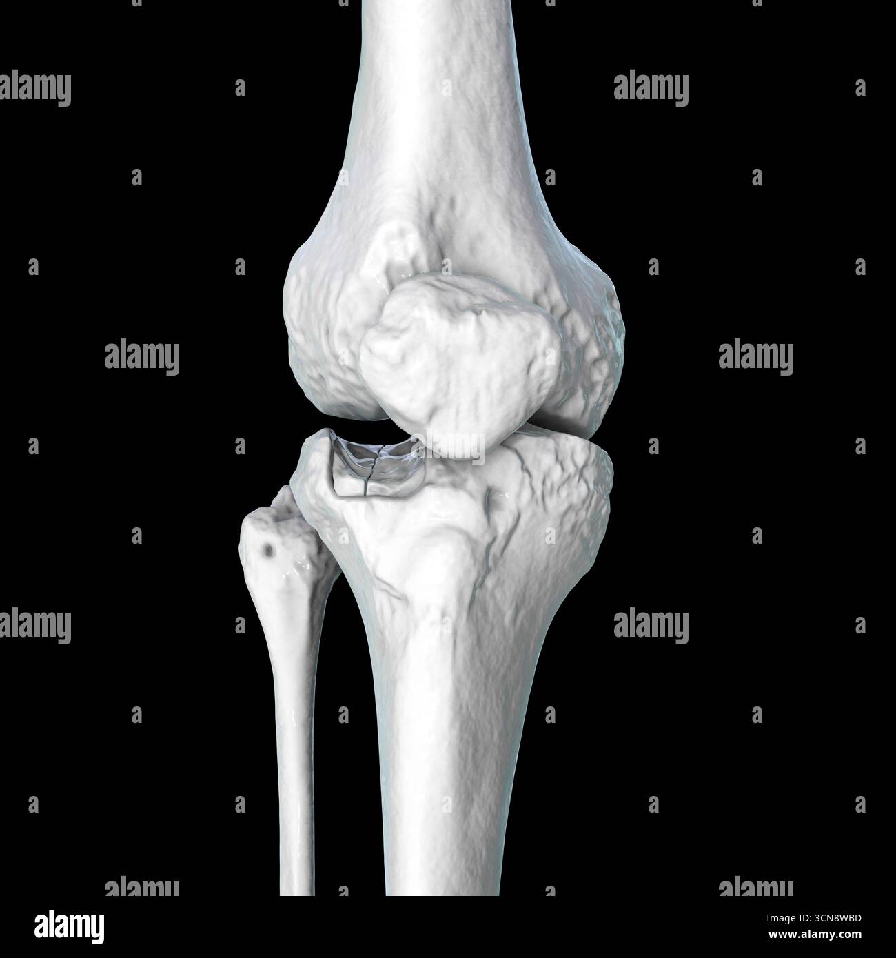 Tibia fracture schatzker type iii hi-res stock photography and images ...
