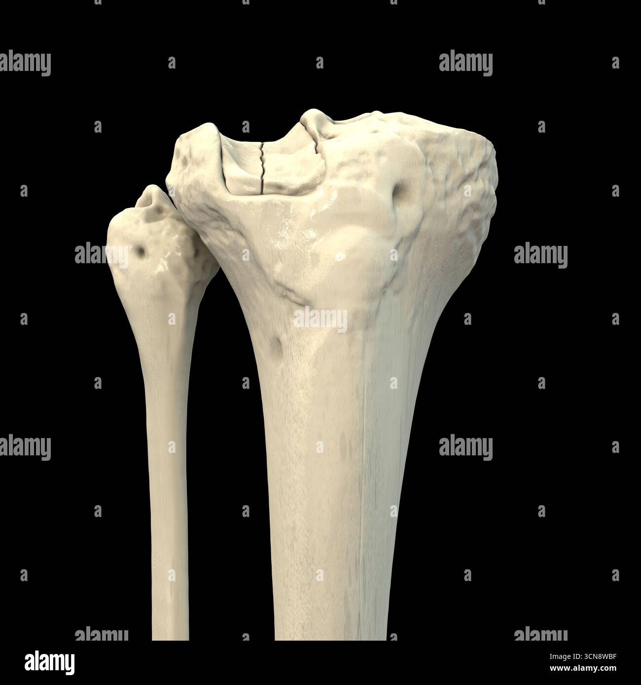Fracture of the tibial plateau hi-res stock photography and images - Alamy