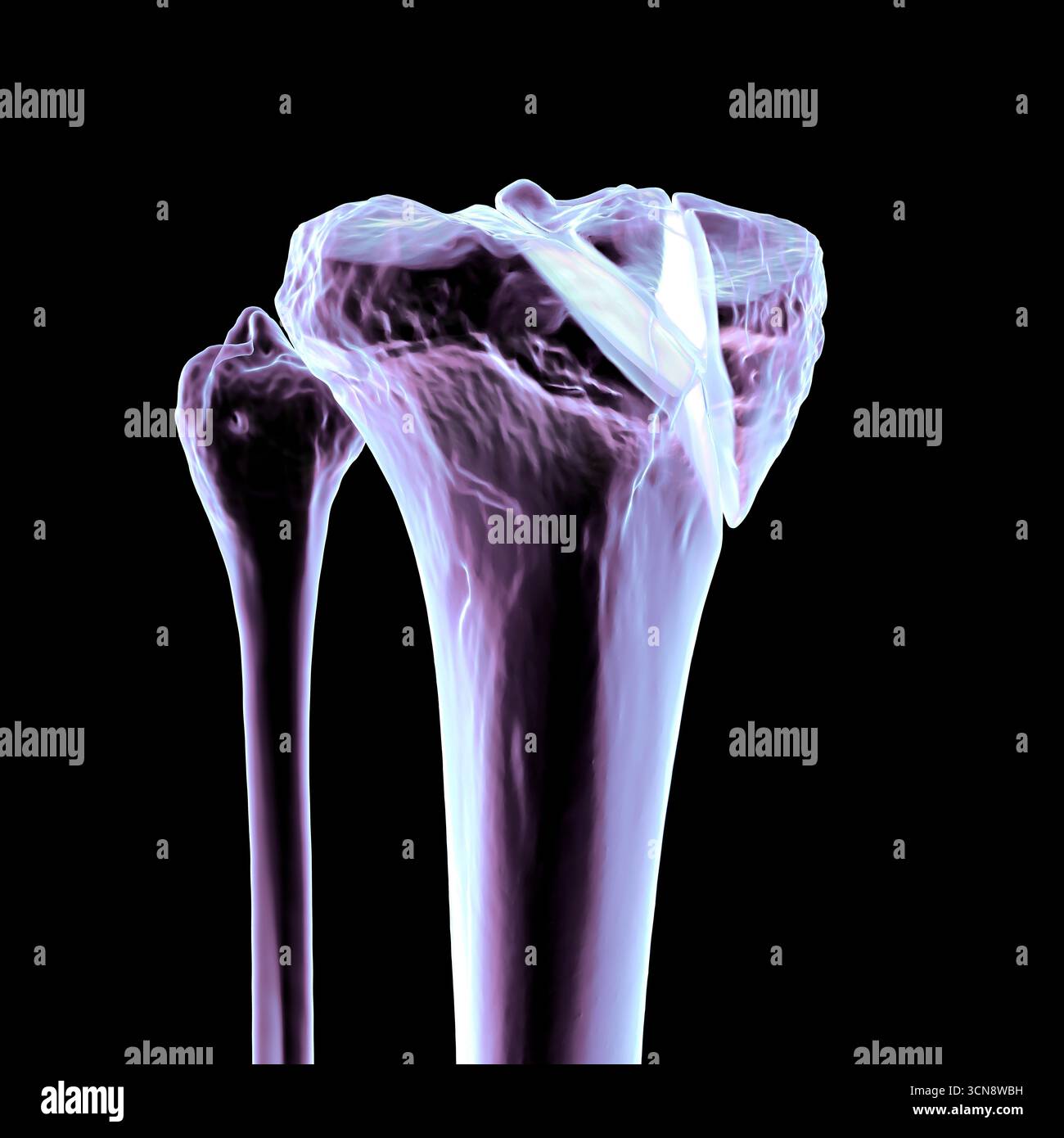 Tibial component hi-res stock photography and images - Alamy