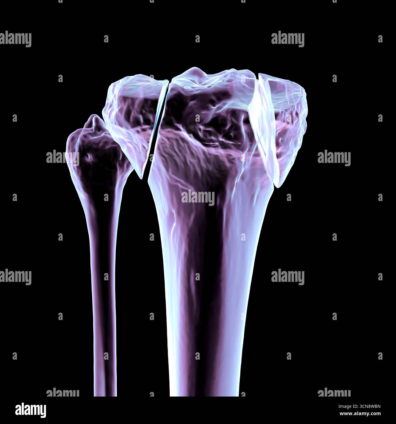 Tibia fracture Schatzker type V. Illustration showing wedge fracture of ...