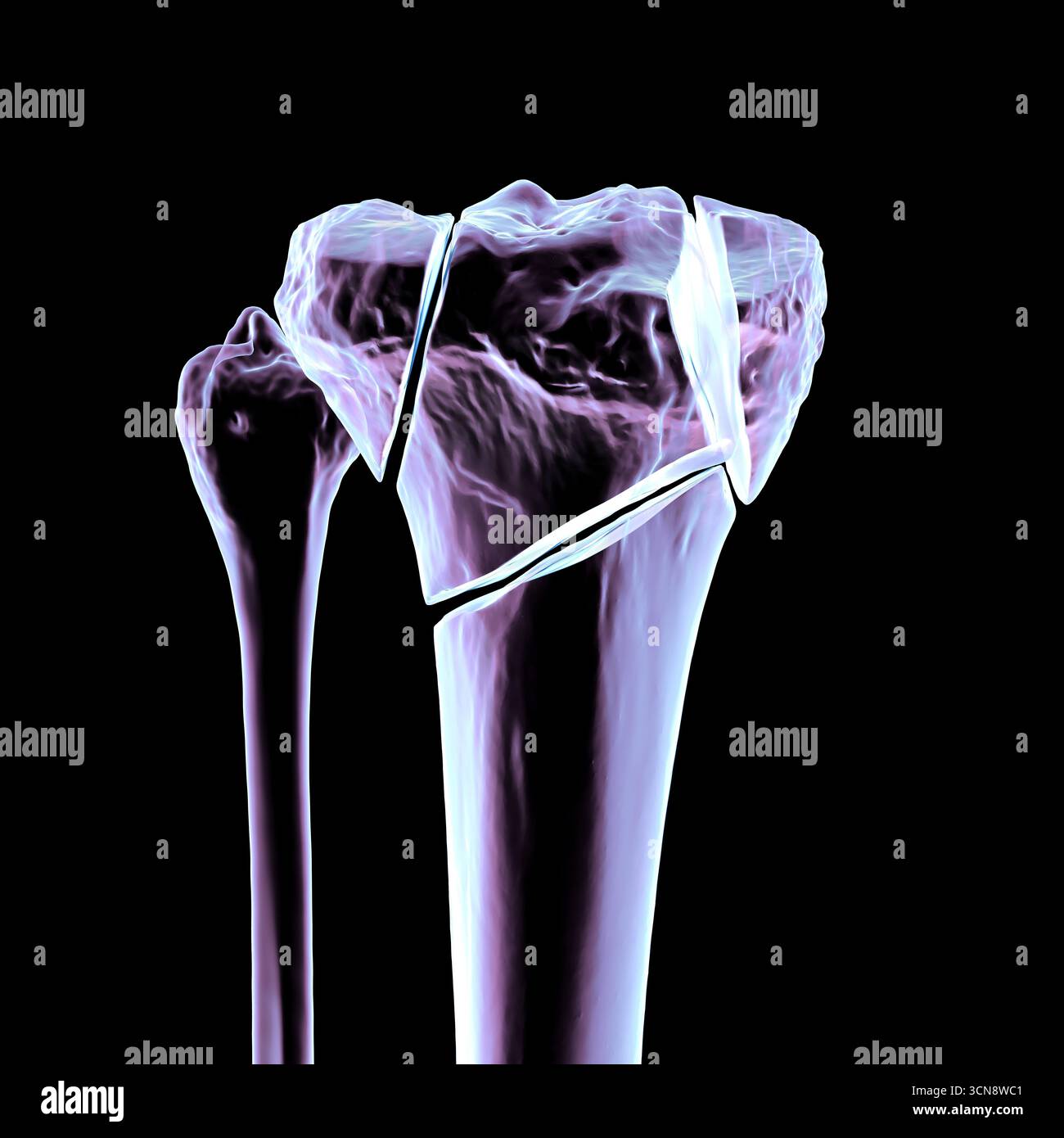 Tibia fracture Schatzker type VI. Illustration showing bicondylar ...