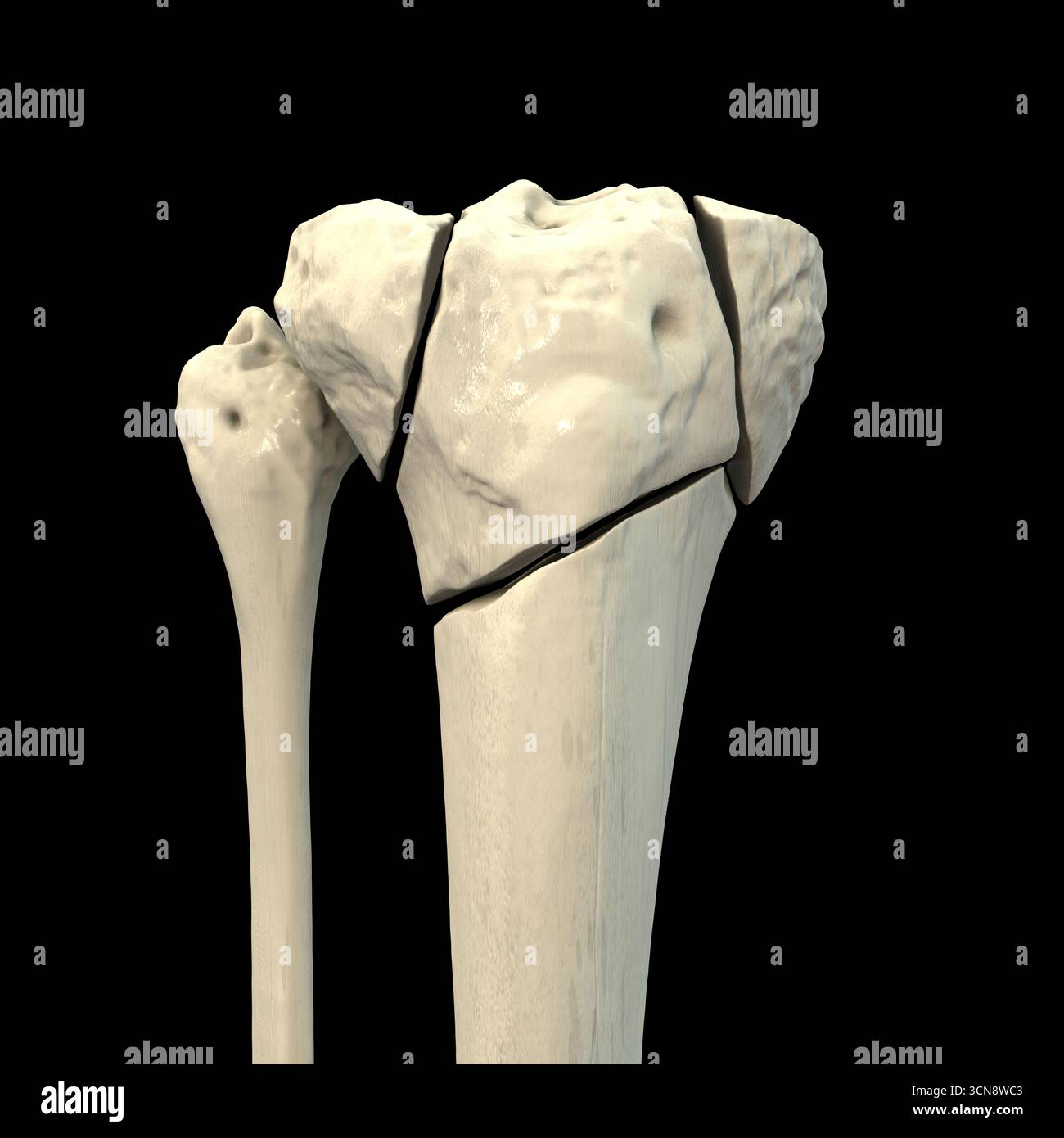 Tibia fracture Schatzker type VI. Illustration showing bicondylar ...