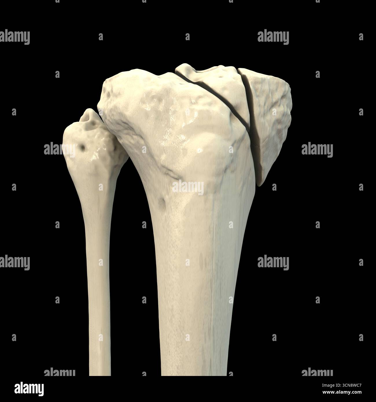 Comminuted fracture tibia bone hi-res stock photography and images - Alamy