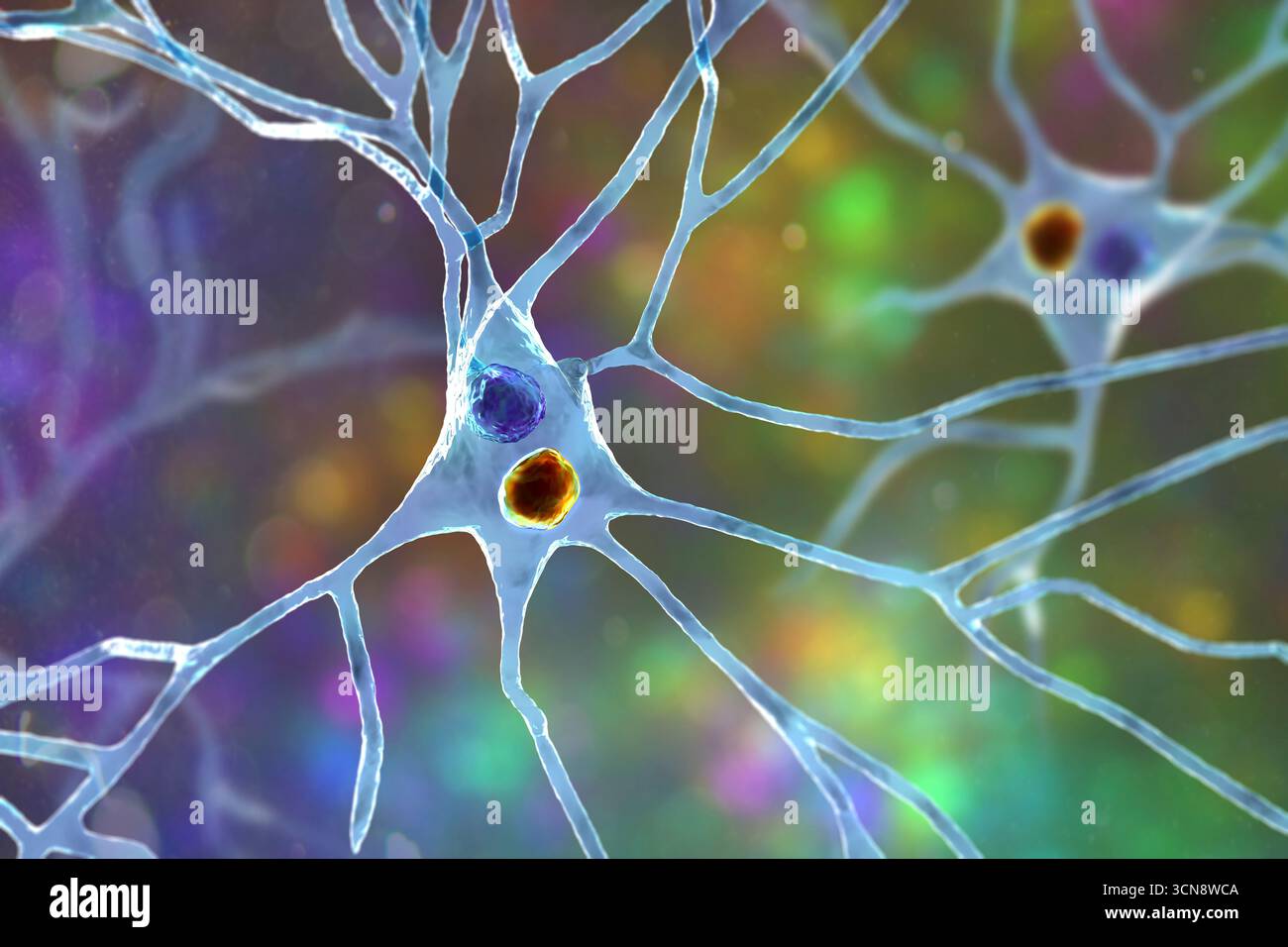 Lewy body dementia. Illustration showing neurons with Lewy bodies ...