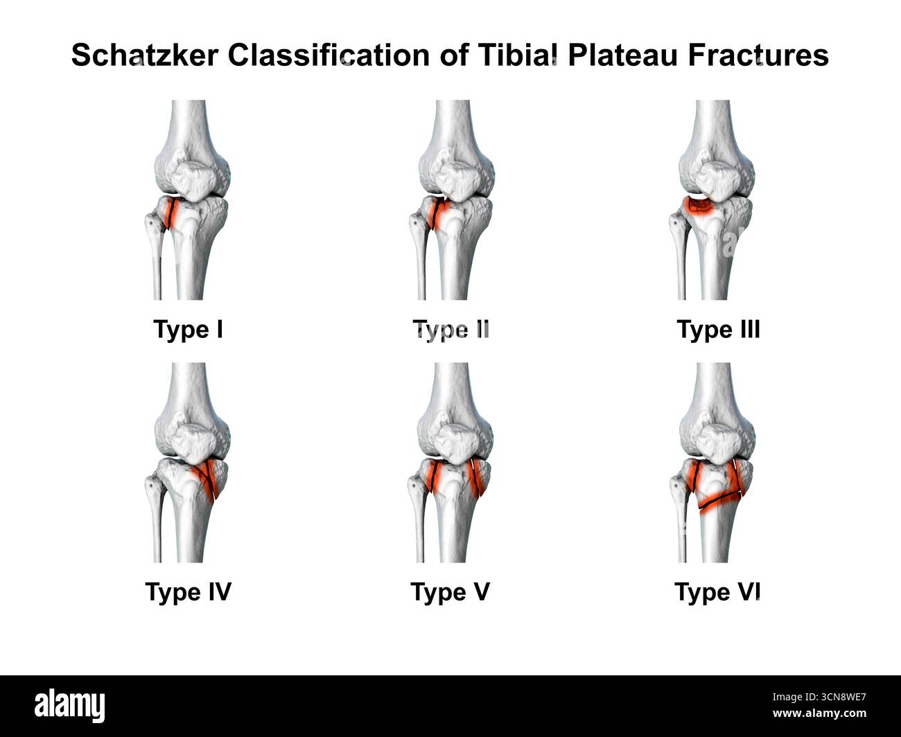 Illustration of the Schatzker classification of tibial plateau ...