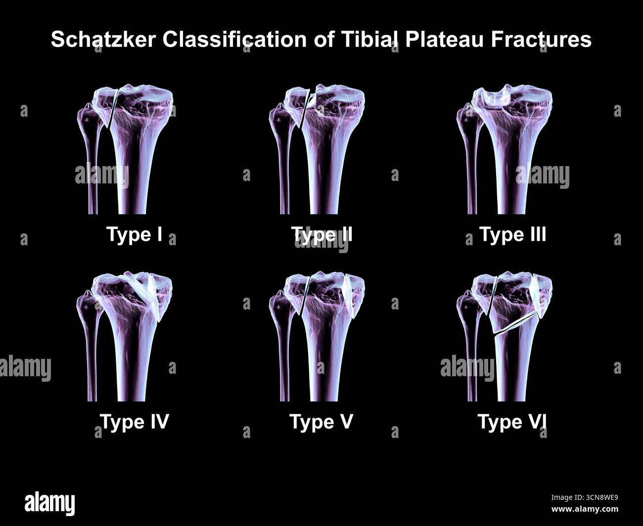 Tibia fracture schatzker type iii hi-res stock photography and images ...