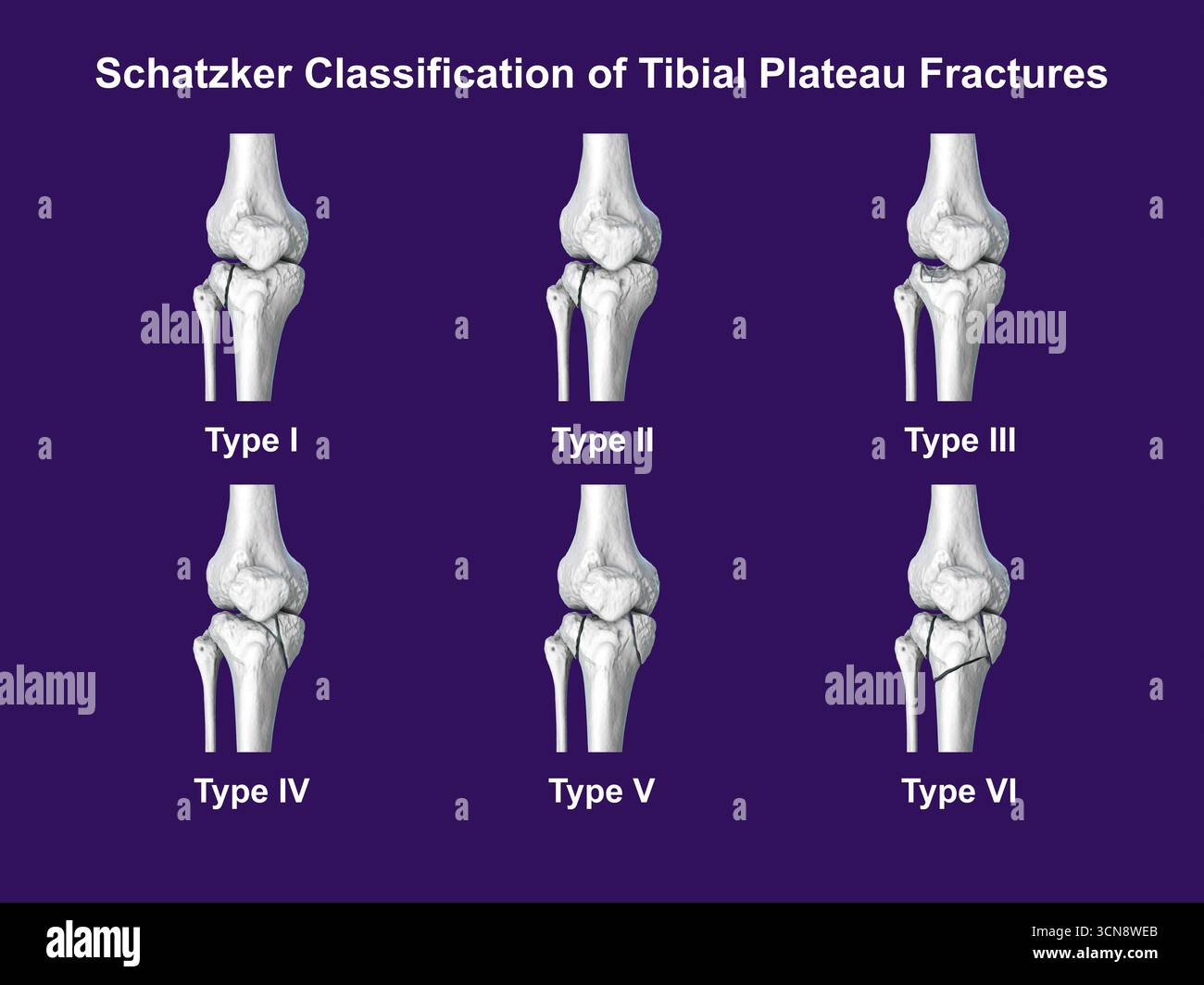 Tibia fracture schatzker type iii hi-res stock photography and images ...