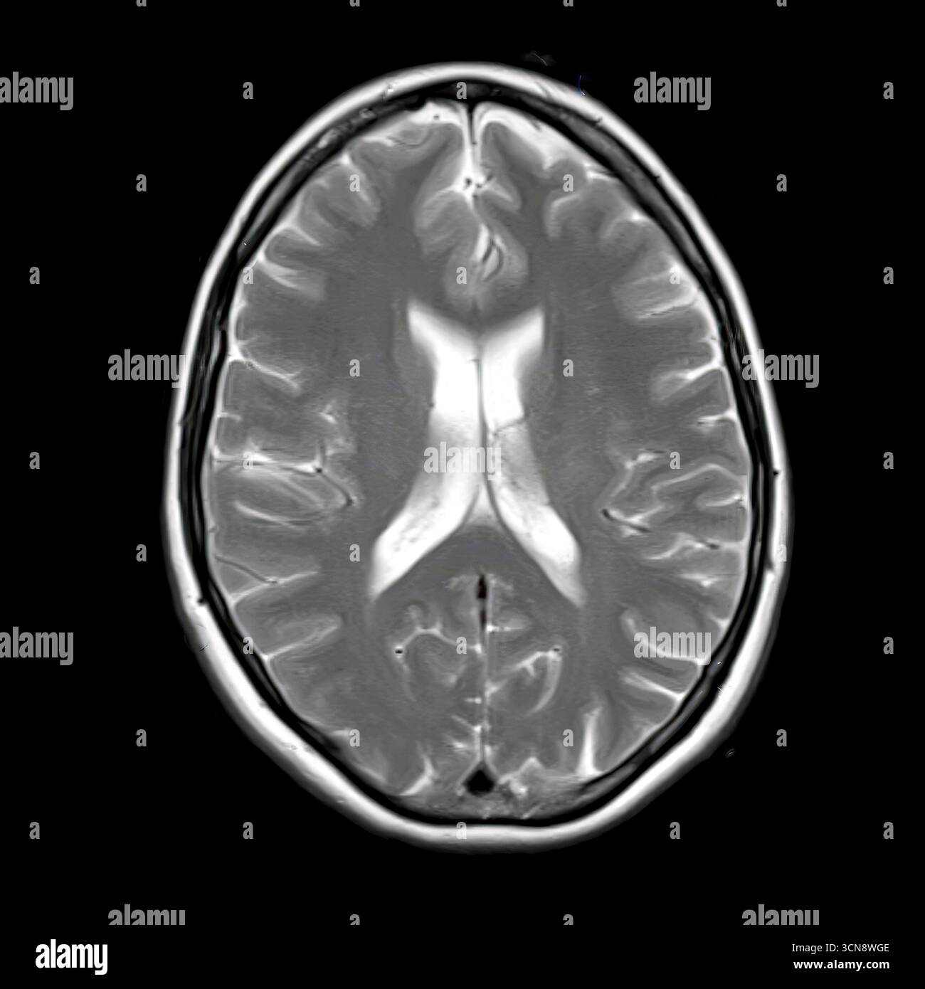 Magnetic resonance imaging (MRI) scan showing normal lateral ventricles ...