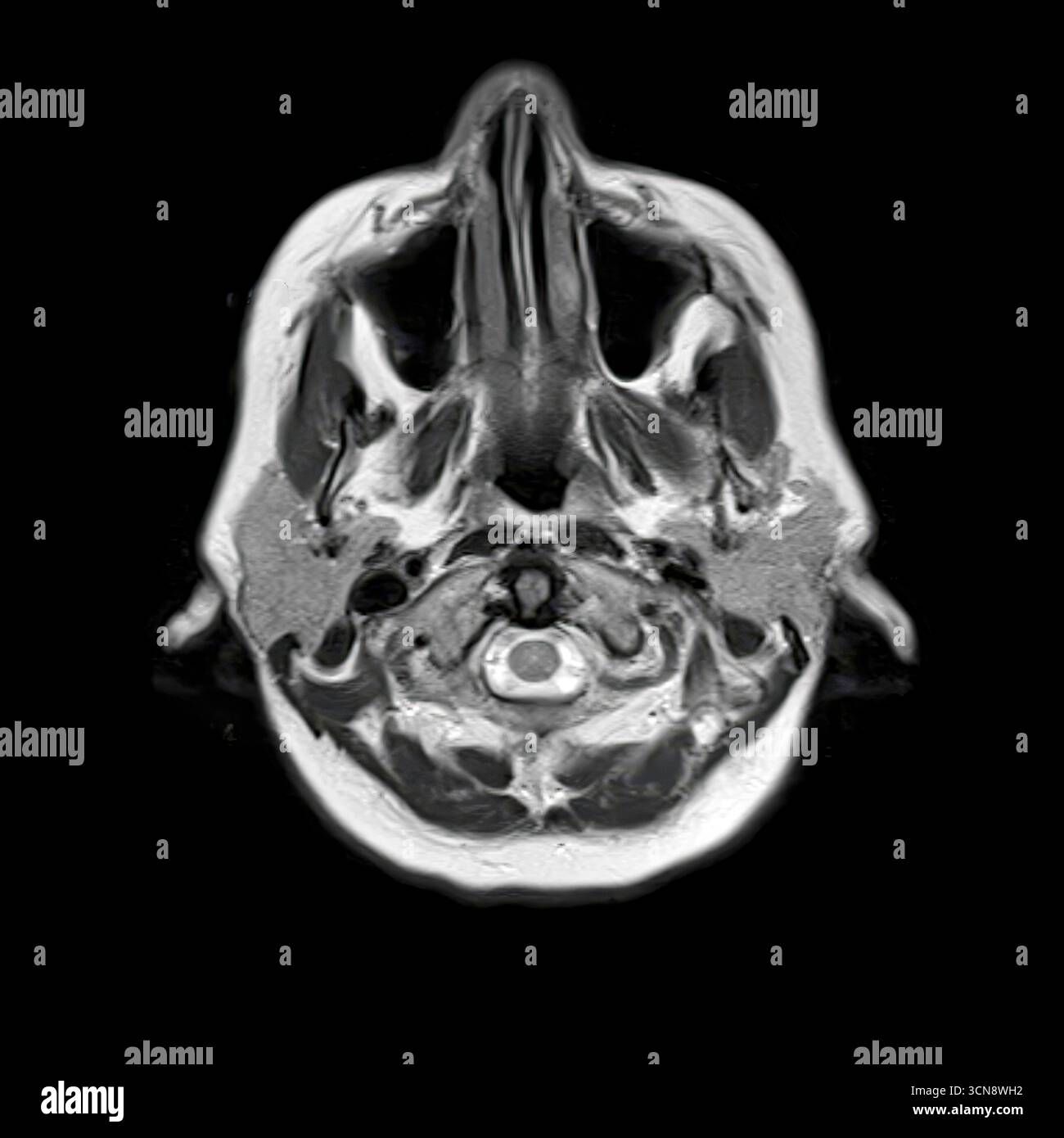 Magnetic resonance imaging (MRI) scan of the human brain at the lower ...