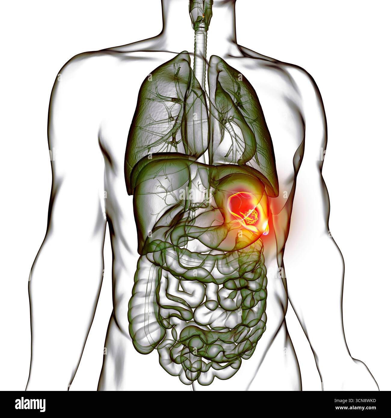 Spleen cancer. Illustration showing malignant growth in the spleen ...