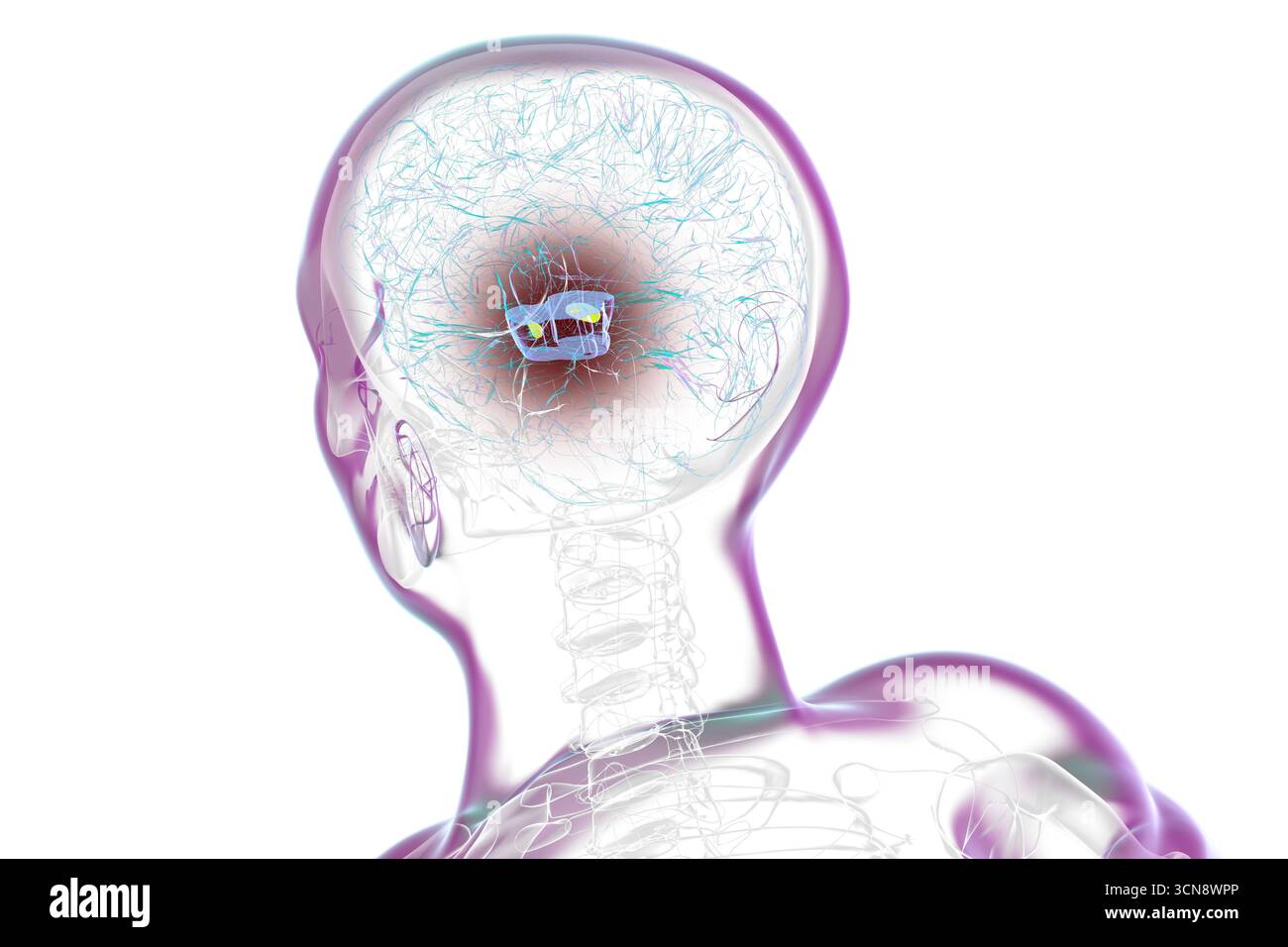 Illustration of a human brain with degenerated substantia nigra in ...
