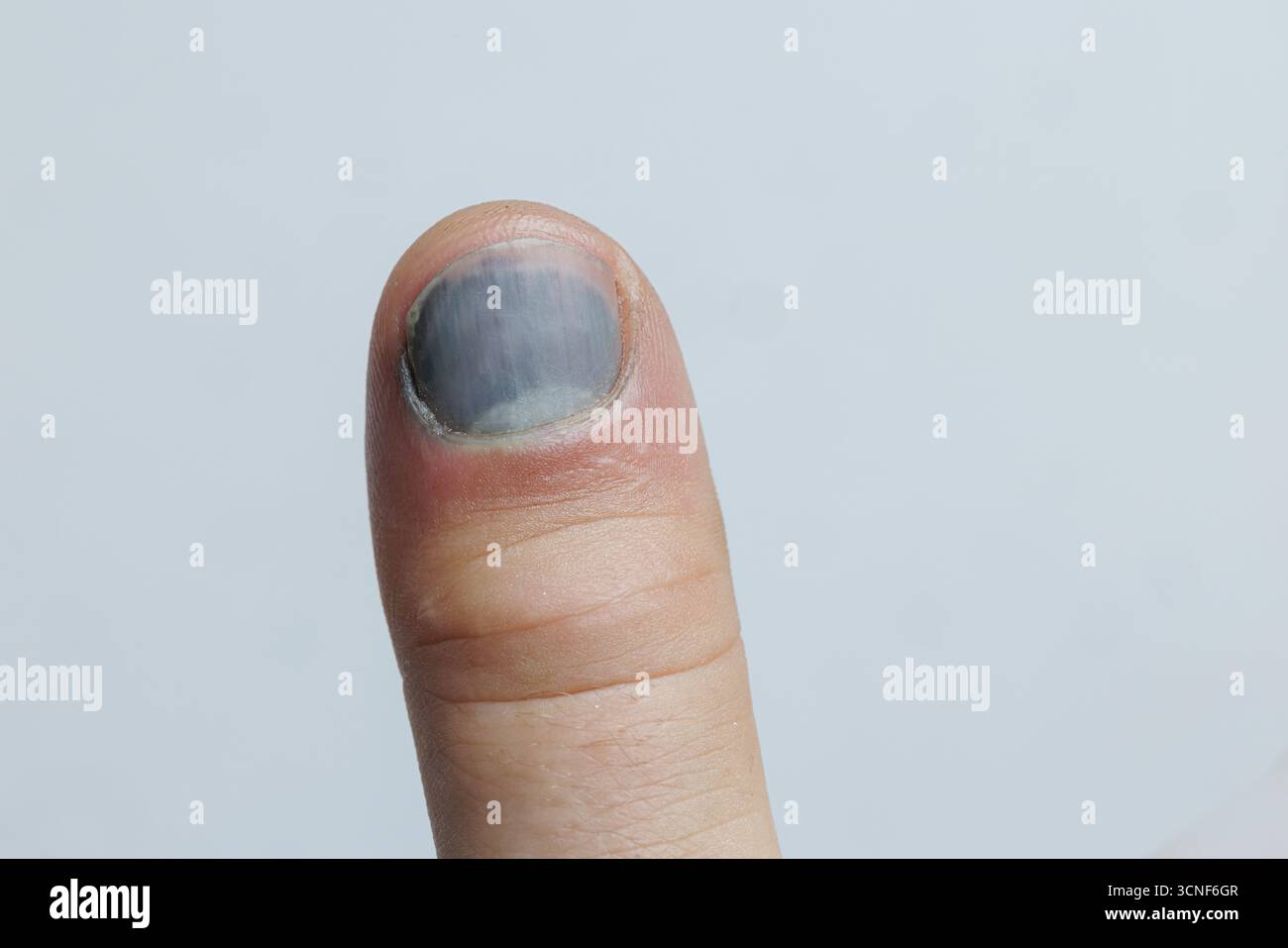 Close up of thumb with subungual hematoma showing dark nail ...