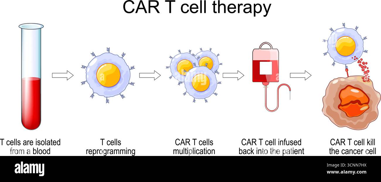 CAR T cell therapy. Cancer immunotherapy. CAR-T-cell therapy for ...